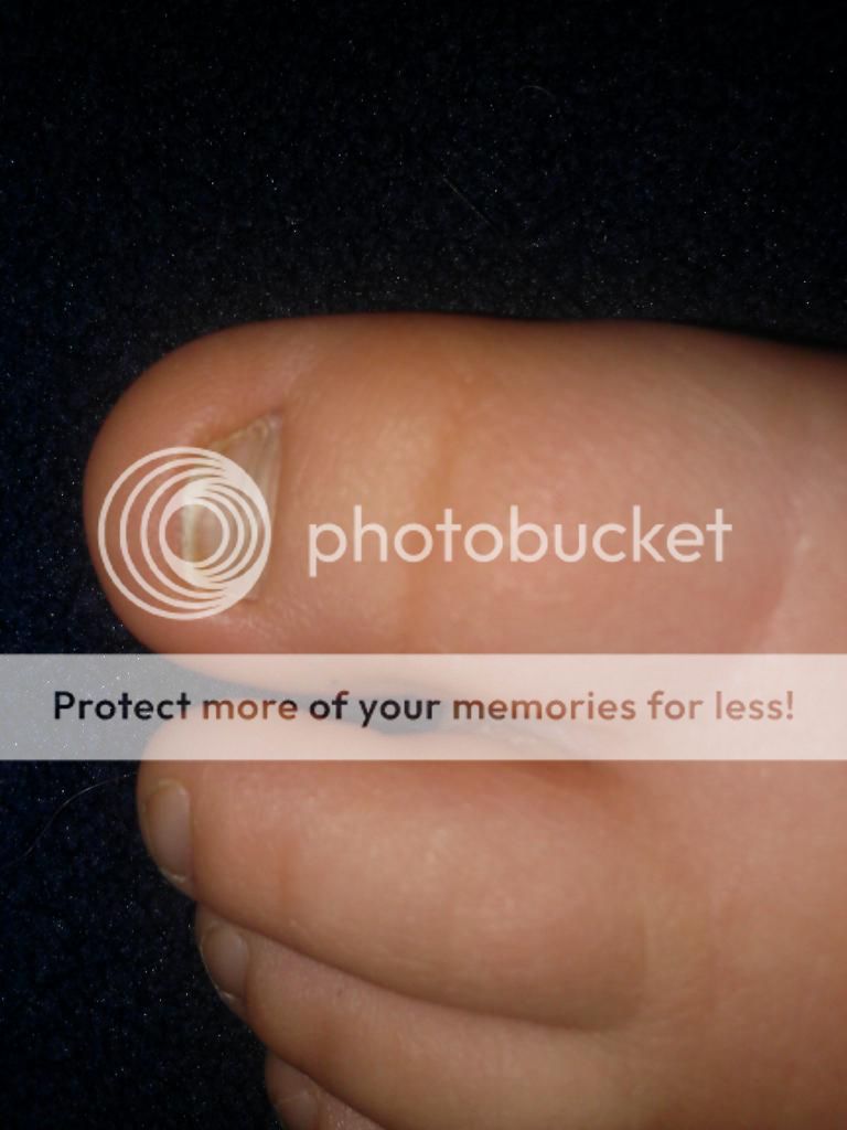 Ingrown toe nails - BabyCenter